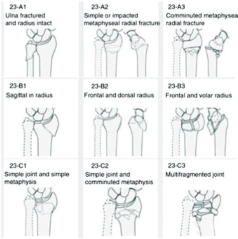 AO classification AO Arbeitsgemeinschaftfür Osteosynthesefragen Download Scientific Diagram