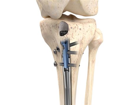 Product Launch Apex Femoral Retrograde Nailing System Orthoxel