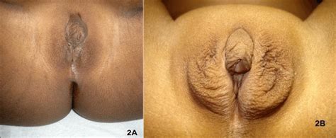 Sex Assignment May Differ In The Same Condition According To The Degree Download Scientific