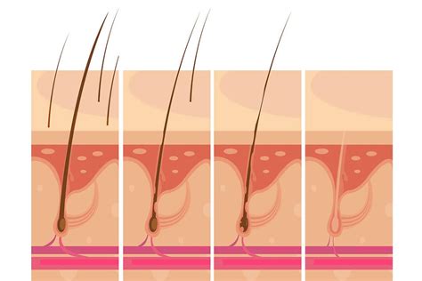 Men Hair Loss Information CHR Clinic