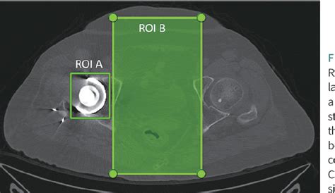 Figure 2 From Comparison Of Metal Artifact Reduction Algorithms In Patients With Hip Prostheses