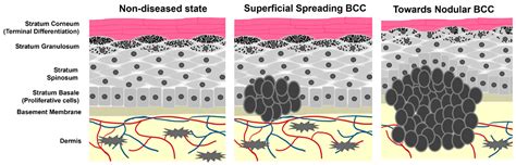 Basal Cell Carcinoma Lip Photosynthesis