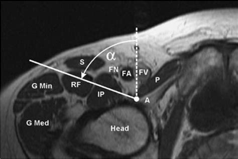 Complications Of Lateral Obturator And Lateral Femoral Nerve Block And Radiofrequency Ablation