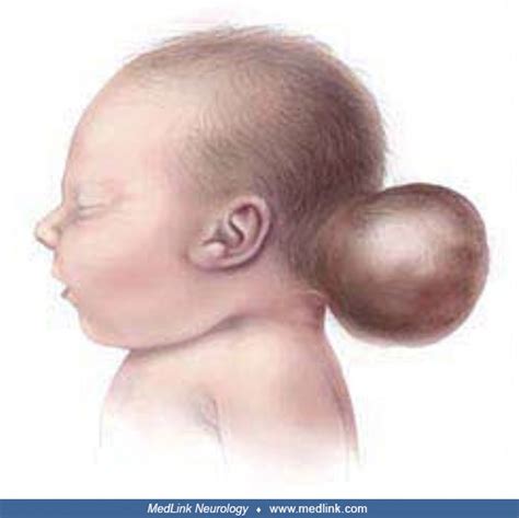 Anencephaly And Other Neural Tube Defects Medlink Neurology