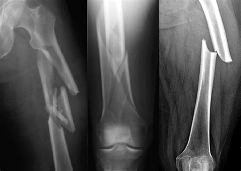 شکستگی و انواع آن