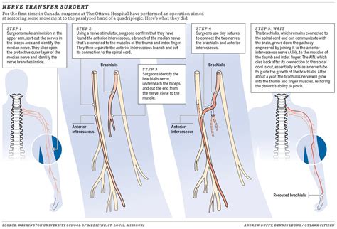 Cpt Code For Nerve Transfer At Maria Gibbs Blog