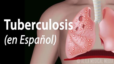 La Tuberculosis Explicada En 4 Minutos