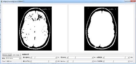 医学图像 填洞 处理 image fill holes csdn博客