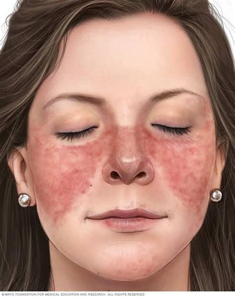 Malar Rash And Photosensitivity Medizzy