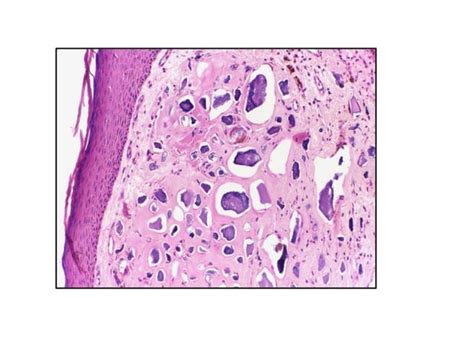 Path Calcification For Mbbs 2nd Year Pathology Pptx Bone And Joint Conditions Diseases And