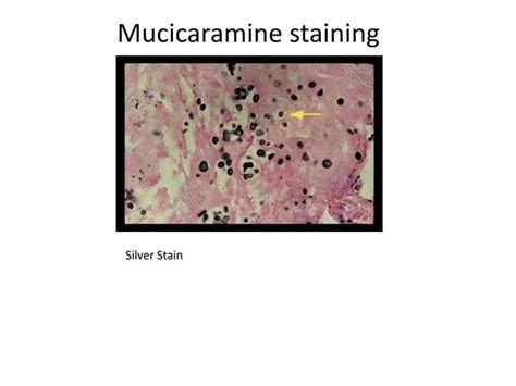 Cryptococcus Pptx Cryptococcus Pptx