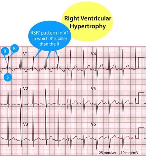 Electrocardiogram Rsr Morphology In V1 Download Scientific Diagram
