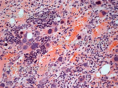 Pancytopenia Lm Stock Image Science Source Images