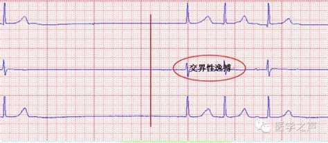 心电图课堂第24期：病态窦房结综合征 搜狐