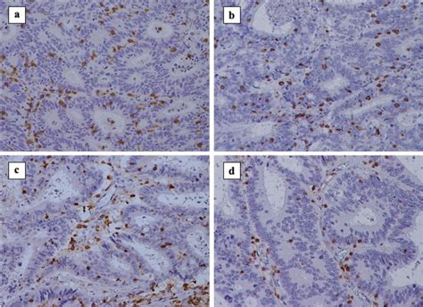 representative cases of high number of cd8⁺ tils and cd45ro⁺ tils in