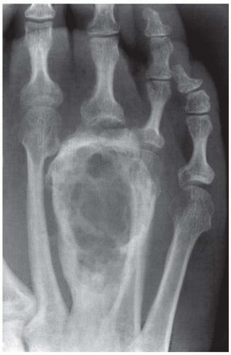 Chondromyxoid Fibroma Musculoskeletal Key