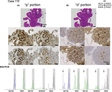 Representative Image Of Mmr‐ihc Of Mosaic Pattern Case 110 Gastric