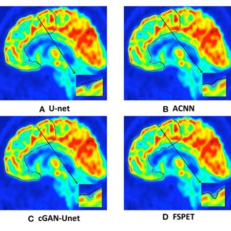frontal cortex segmentation in median sagittal section of brain