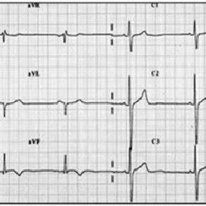 Left Posterior Fascicular Block Download Scientific Diagram