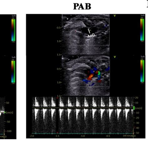 Validation Of Neonatal Pulmonary Hypoperfusion In Pab Rats At Postnatal