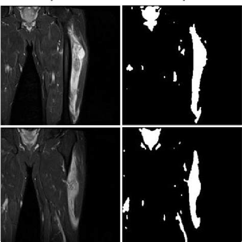 Segmentation Of Leg Images A Normal Leg Image B Segmented Image Download Scientific Diagram