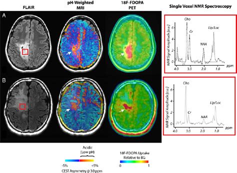Spatial Correspondence Between Ph Weighted Molecular Mri 18 F Fdopa