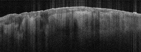 Bcc And Scc Vivosight