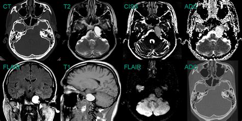 Cholesterol Granuloma Neuroradiology