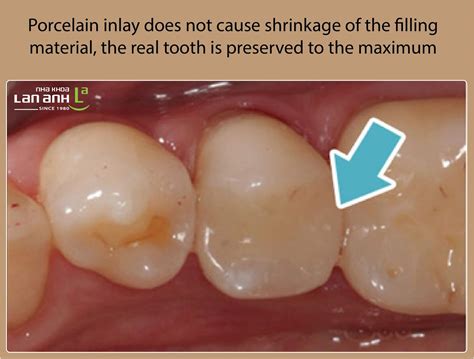 Porcelain Inlay Modern Dental Filling Techniques With CAD CAM System