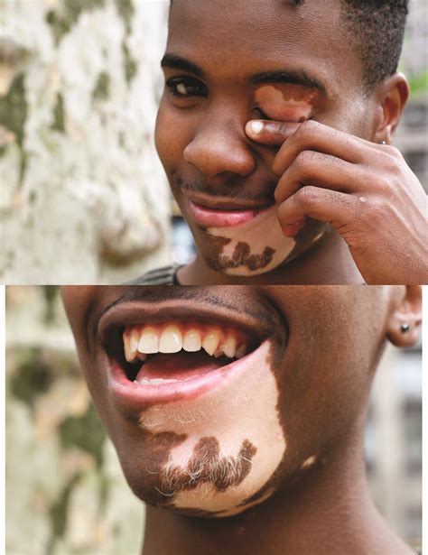 What Is Skin Vitiligo At Ann Kennedy Blog