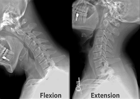 Cervical Spine Dynamics A Comprehensive Analysis Of Flexion Extension X Ray Radiographs