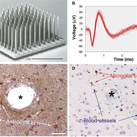 Pdf Acute Human Brain Responses To Intracortical Microelectrode Arrays Challenges And Future