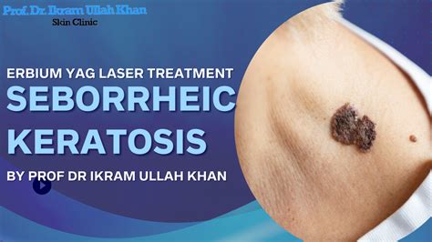 Laser Ablation For Seborrheic Keratosis At Ruth Tolbert Blog
