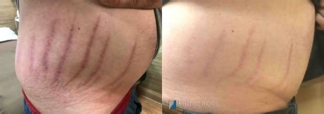 Vbeam Laser For Stretch Marks Before And After The Best Picture Of Beam