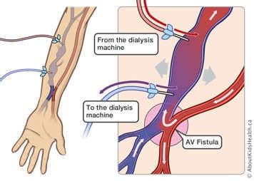 Hemodialysis Using An Av Graft Or Av Fistula For Ease Of Access