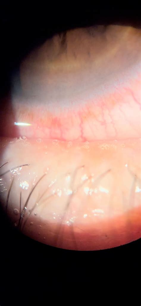 Nathaniel Harooni Od On Linkedin Staphylococcus Secretes Lipase Enzymes Which React With And