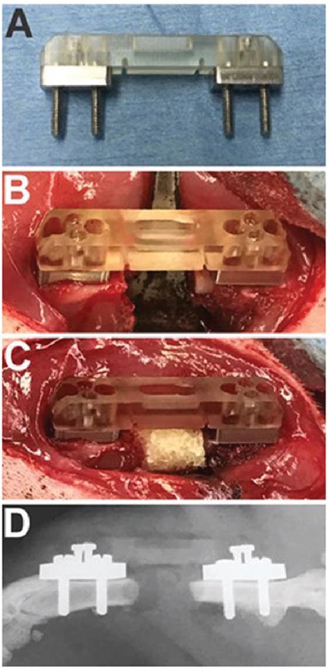 Figure 1 From Improved Osteogenesis In Rat Femur Segmental Defects Treated With Human Allograft