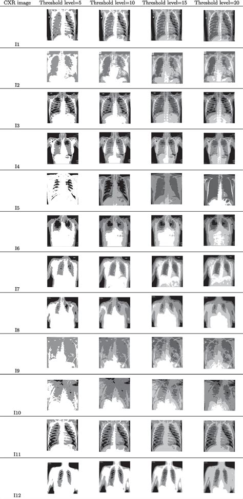 The Segmented Cxr Images I1 I12 Using Csapso For Threshold Level