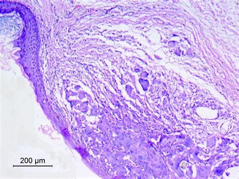 Pathology Outlines Ectodermal Cysts