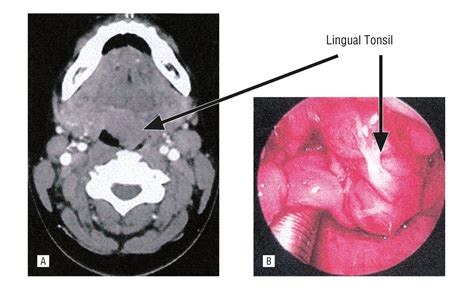 Lingual Tonsils Hypertrophy Lingual Tonsil Hypertrophy As A Cause Of