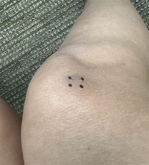 Morphea Atrophy R Scleroderma