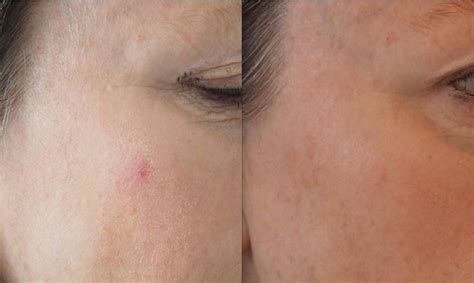 Remove Red Spots On Face