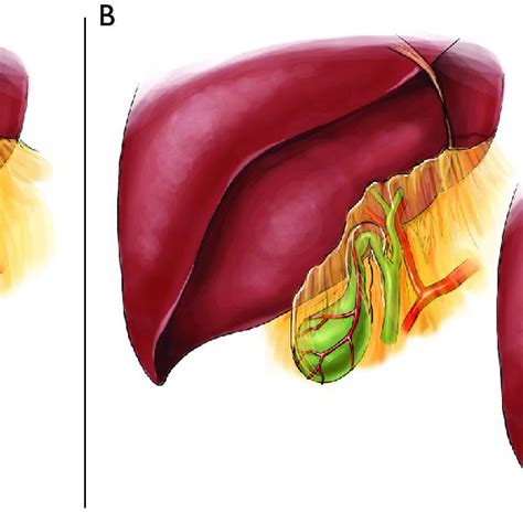 Gallbladder Volvulus A Normal Gallbladder B Anatomical Variant Of Download Scientific Gallbladder Volvulus A Normal Gallbladder B Anatomical Variant Of Download Scientific