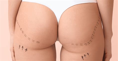 Gluteal Augmentation Bbl Fat Grafting And Buttock Implants Surgery In