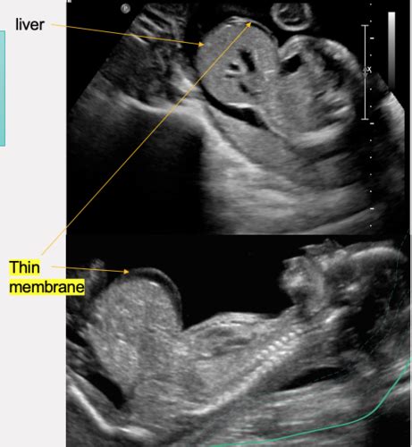 Abdominal Abnormalities Flashcards Quizlet