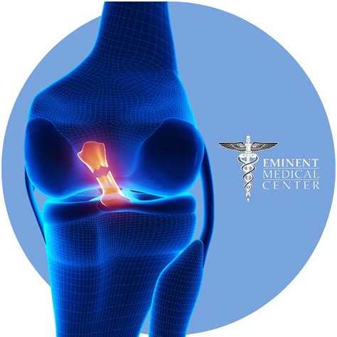 Acl Tear Treatment In Richardson Tx Eminent Medical Center