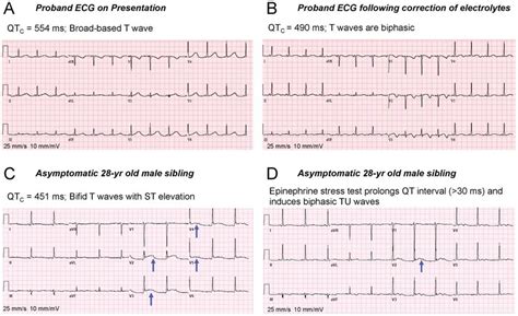Lead ECG Of Proband And Sibling QTc Prolongation Was Observed Download Scientific Diagram