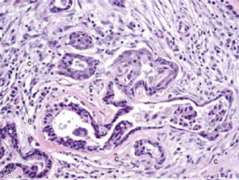 General Pathology Exam 3 Neoplasia Only Flashcards Quizlet
