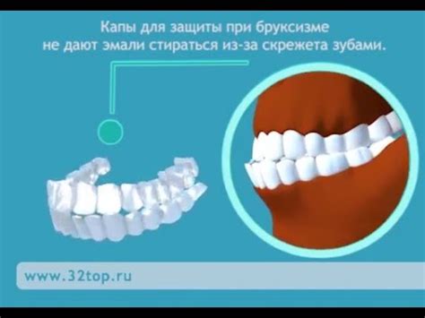 Капы для зубов - YouTube