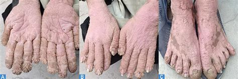 Acitretin Treatment Improves A Case Of Severe Generalized Epidermodysplasia Verruciformis Mayo